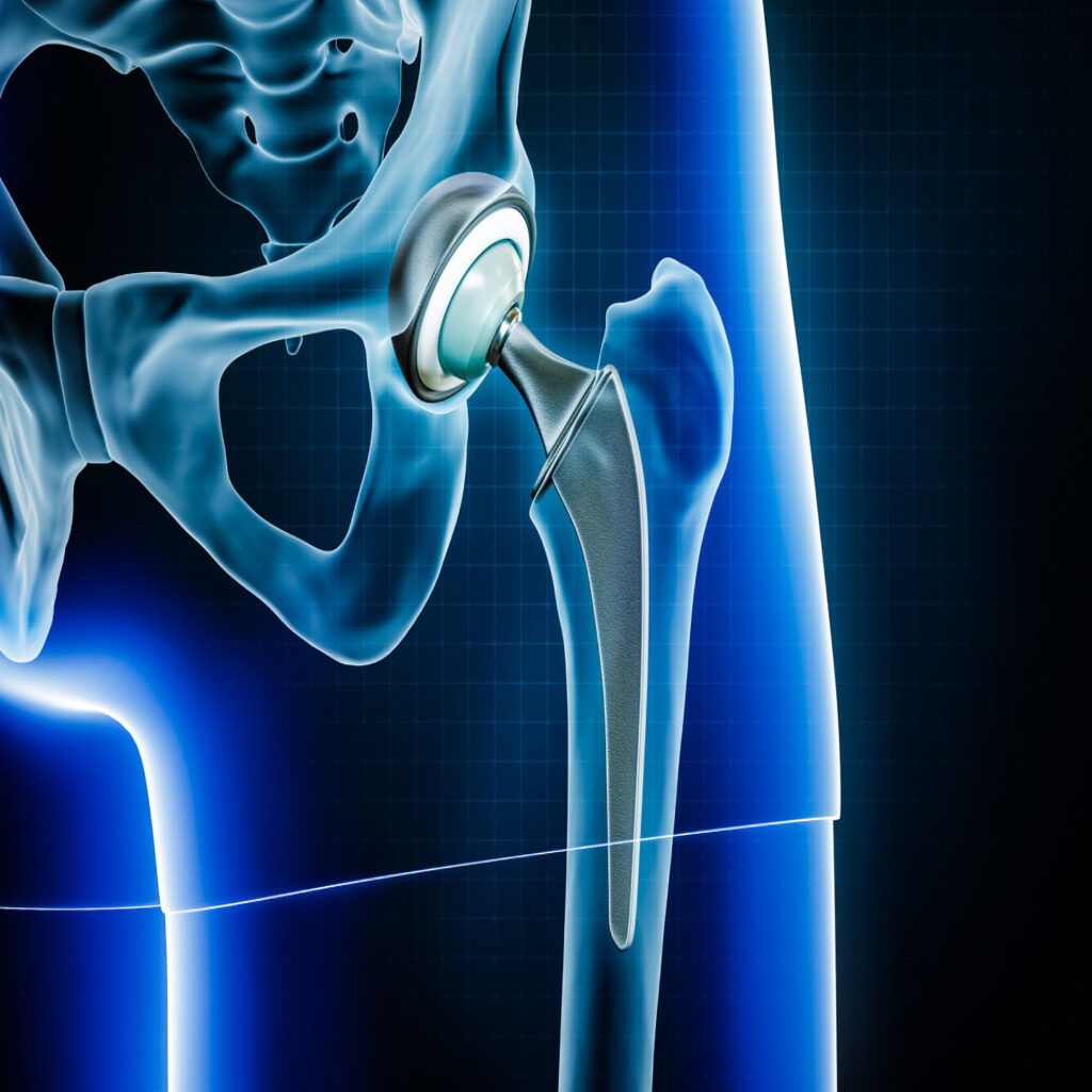 THE ULTIMATE GUIDE TO HIP REPLACEMENT: RESTORING MOBILITY AND QUALITY ...